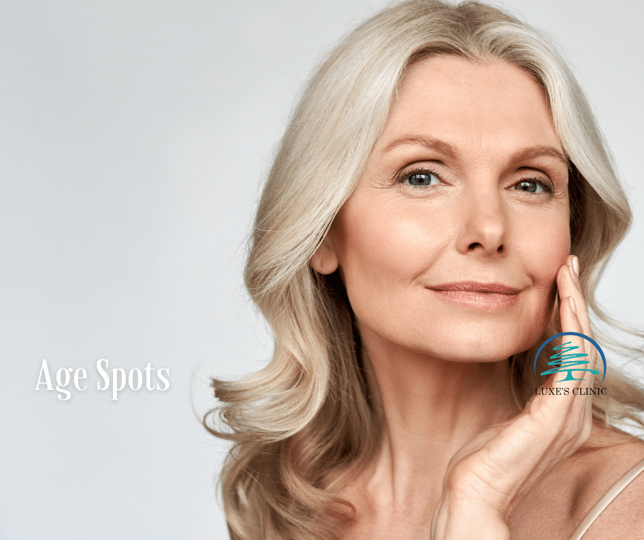 Advanced Age Spots Treatment Services - Luxe’s Clinic