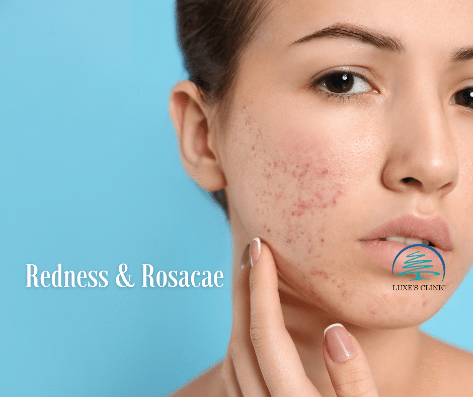Redness and Rosacea Treatment Services - Luxe’s Clinic