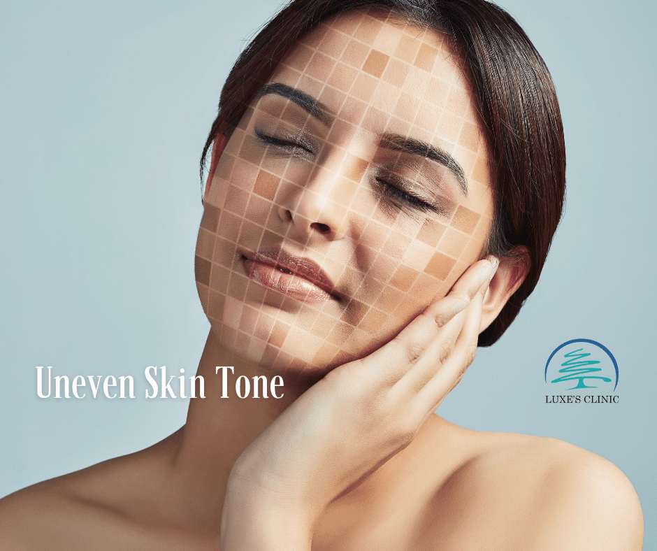 Say Goodbye to Uneven Skin Tone - Luxe’s Clinic Offers Advanced Skin ...